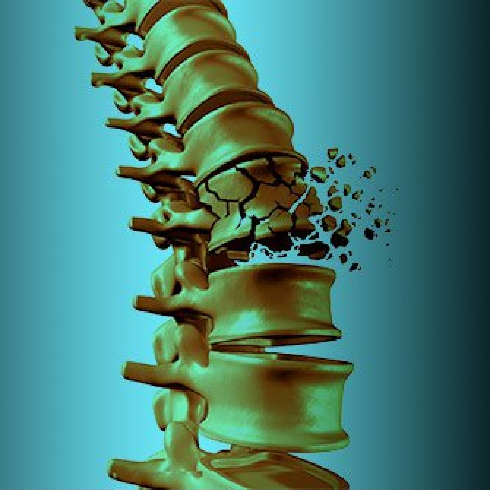 Οστεοπορωτικά Κατάγματα, κατάγματα σπονδύλων,οστεοπορωση, οστεοπενια ...